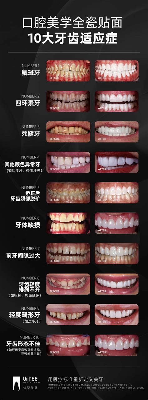 牙贴片图片 牙图片卡通图片 第2页 大山谷图库