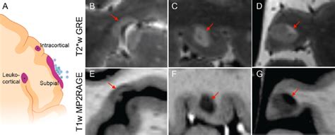 Topography And Imaging Appearance Of Cortical Lesions A Cortical