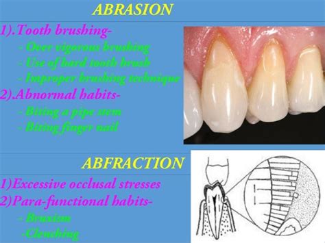 Non Carious Cervical Lesion