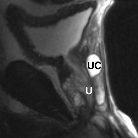 Prostatic Utricle Cyst