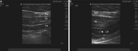 Truncal Blocks Paravertebral Intercostal Pectoral Nerve Suprascapular Ilioinguinal