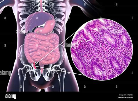 Acute Suppurative Appendicitis Computer Illustration And Light