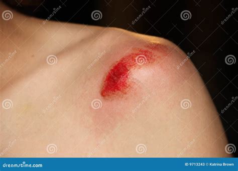 Shoulder Injury In Humans Shoulder Painjoint Pains People Medical