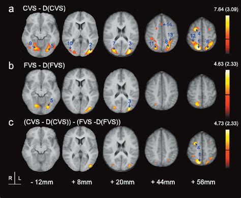 Cortical Activation During Performance Of Feature And Conjunction