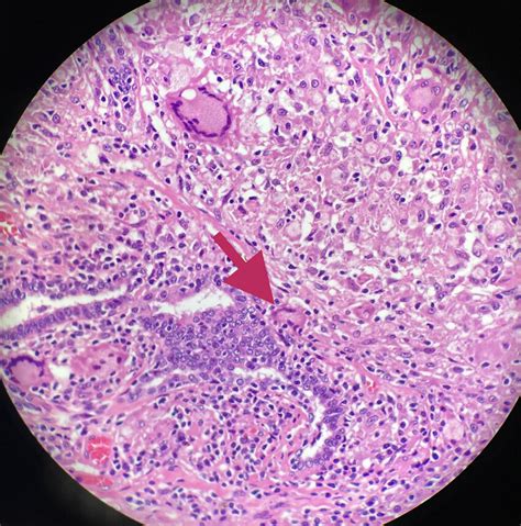Right Lower Lobe Intralobar Sequestration Histopathology Under Hande Download Scientific Diagram