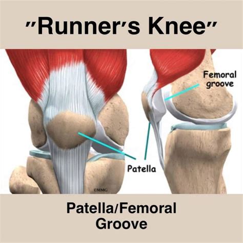 Patellofemoral Syndrome Relief For Knee Pain