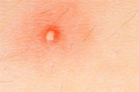 Bumps On Skin Skin Mysteries Explained Readers Digest