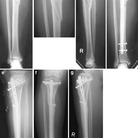 Distribution Of 185 Tibia Fractures According To The Ao Classification Download Scientific Diagram