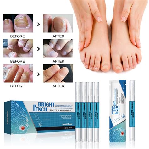 손톱 곰팡이 치료 에센스 펜 발 수리 손톱 곰팡이 제거 세럼 젤 손발톱 진균증 감염 방지 제품 Aliexpress