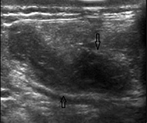 Ultrasonography With Linear Transducer Reveals A Hypoechoic Tubular Download Scientific