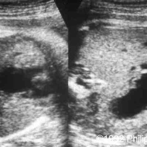 📃 Polysplenia Syndrome