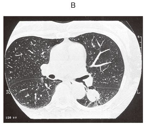 90d37 胸部エックス線 国試 M3e Medical
