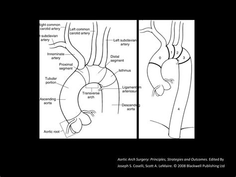 Complex Aortic Arch Surgery Pptx