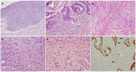 Histological And Immunohistochemical Features Of Pt1 Colorectal Cancer Download Scientific