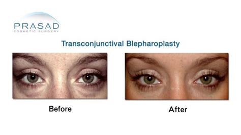 Under Eye Bag Surgery Prasad Cosmetic Surgery New York