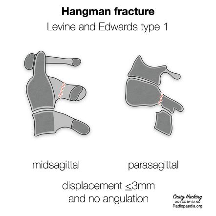 Hangman Fracture Fractures And Dislocations C2 Hangmans Fracture