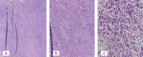 Diagnostic Challenge Of Mixed Endometrial Adenocarcinoma With A Small Cell Neuroendocrine