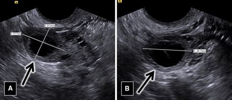 Corpus Albicans Ultrasound