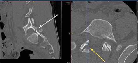 Computed Tomography Ct Of The Lumbar Spine There Is Evidence Of An Download Scientific