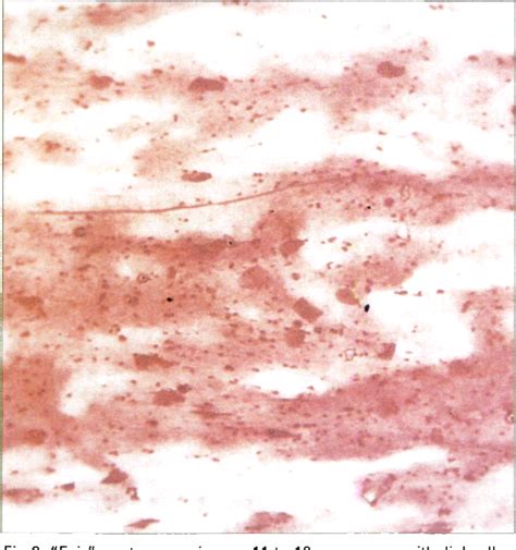 Figure 1 From Interpreting The Sputum Gram Stain Report Semantic Scholar