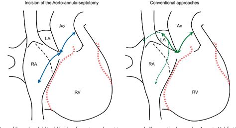 Figure 1 From Modified Commando Procedure Using A Double Valve
