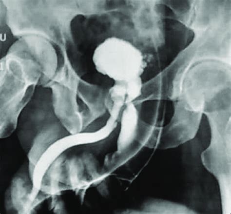 Ascending Urethrogram Showing Leakage Of Contrast From The Posterior