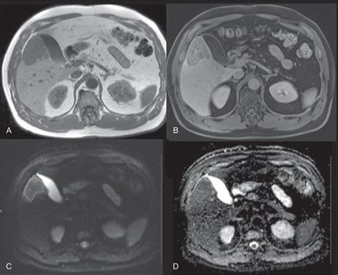 Image Analysis Process The Lesion Peripheral Cholangiocellular Download Scientific Diagram