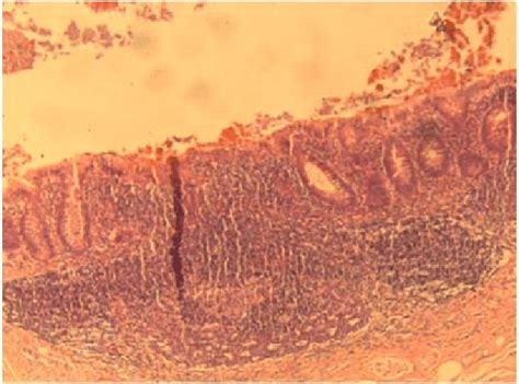 Photograph Of The Histology Of The Removed Appendix Showing Features Of Download Scientific