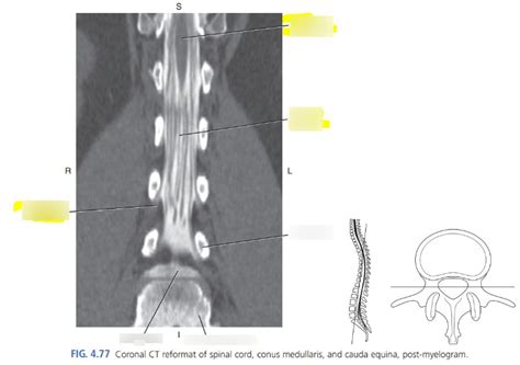 Coronal Ct 2 Diagram Quizlet