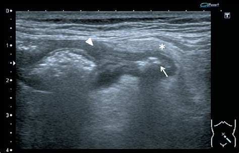 Transabdominal Ultrasonography With A 7 5 Mhz Linear Array Transducer Download Scientific