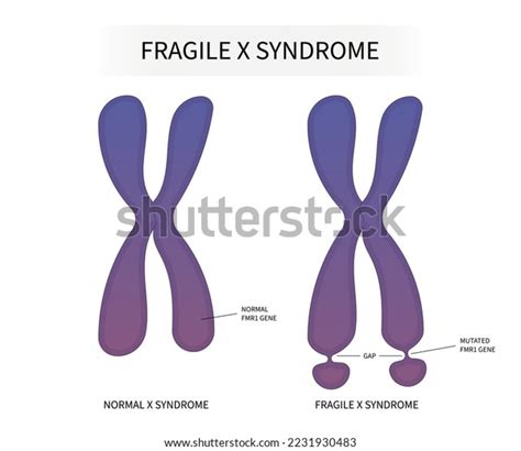 Dna Disorder Testing Fragile X Syndrome Stock Vector Royalty Free 2231930483 Shutterstock