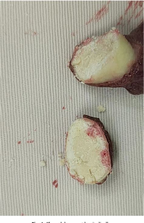 Figure 3 From Successful Surgical Treatment Of Extensive Idiopathic