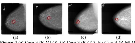 Figure 4 From Exploring Breast Cancer Texture Analysis Through Multilayer Neural Networks