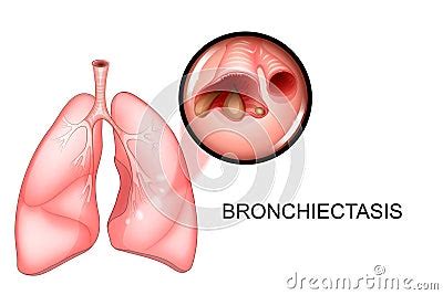 Lungs Affected By Bronchiectasis Disease Cartoon Vector CartoonDealer Com 97741465