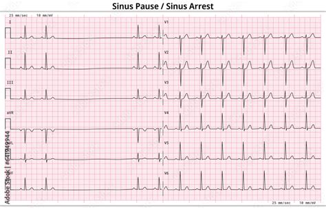 Sinus Arrest Sinus Pause Ecg Paper 12 Lead Vector Medical