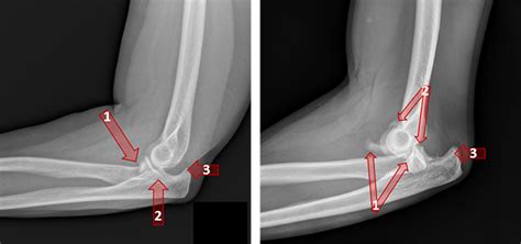 Elbow Fracture Dislocation