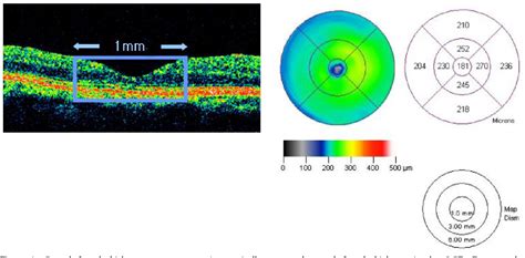 Figure 1 From Evaluation Of Correlation Between OCT Findings And Delayed Visual Acuity
