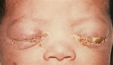 Neonatal Conjunctivitis Wikipedia