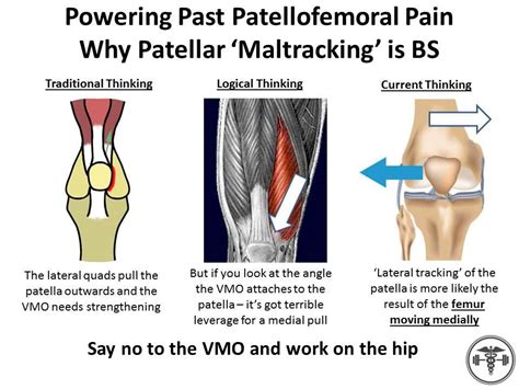 [patellar Dislocation Causes And Treatment] Byamj