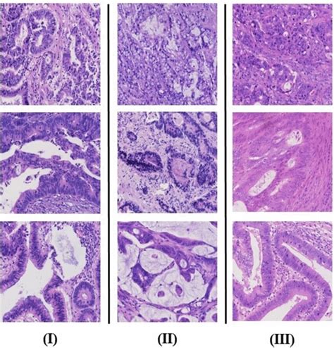 Different Differentiation Types Of Crc Under 40× Magnification On The