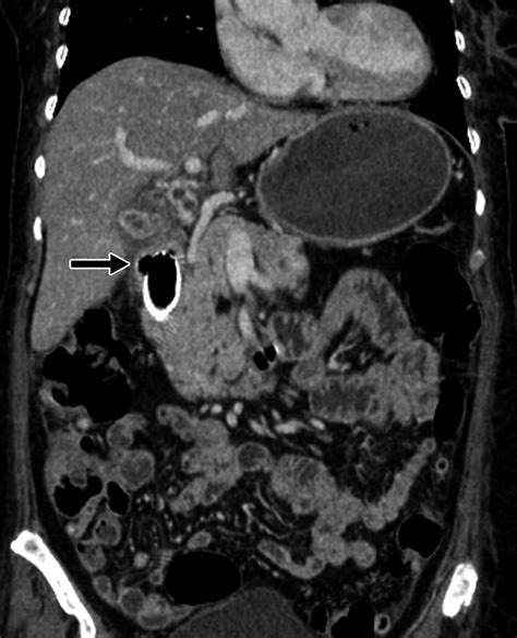 Complications Of Biliary And Gastrointestinal Stents Mdct Of The