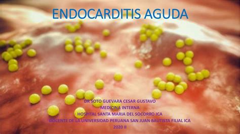 Endocarditis Aguda Dr Soto Ii Henry Maldonado Gutiérrez Udocz