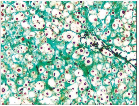 Criptococosis Gástrica En Un Paciente Con Vihsida
