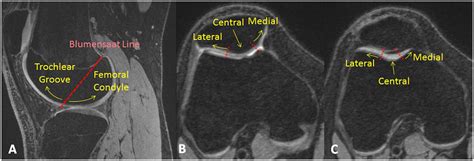 A Sagittal View Showing Separation Of Cartilage On The Femur Into