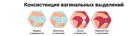 Выделения из влагалища — причины виды современные подходы к