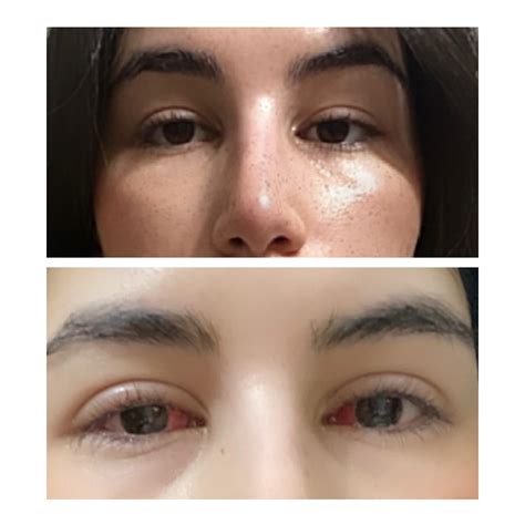One Day Post Bilateral Surgery I Had Esotropia Mostly On My Left Eye