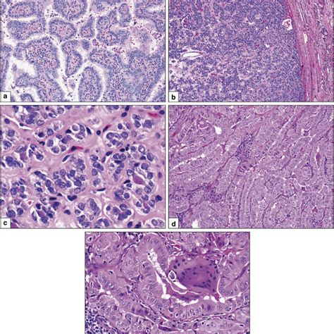 Papillary Thyroid Microcarcinoma A Classic Variant 7 Mm In A