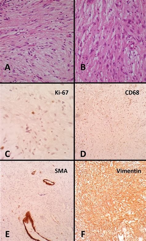 A B Histopathologic Features Of The Maxillary Mass In The First