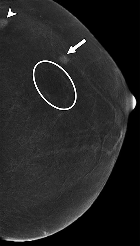Contrast Enhanced Mammography A Systematic Guide To Interpretation And