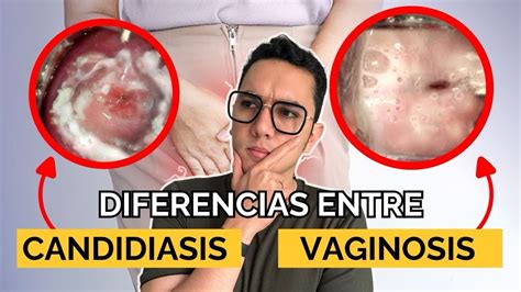 Diferencias Entre Candidiasis Y Vaginosis Dr William Guerrero Youtube